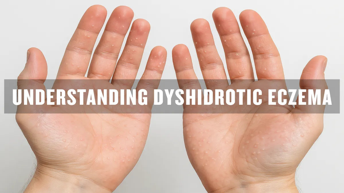 What is Dyshidrotic Eczema? Complete Treatment Guide | HarlanMD